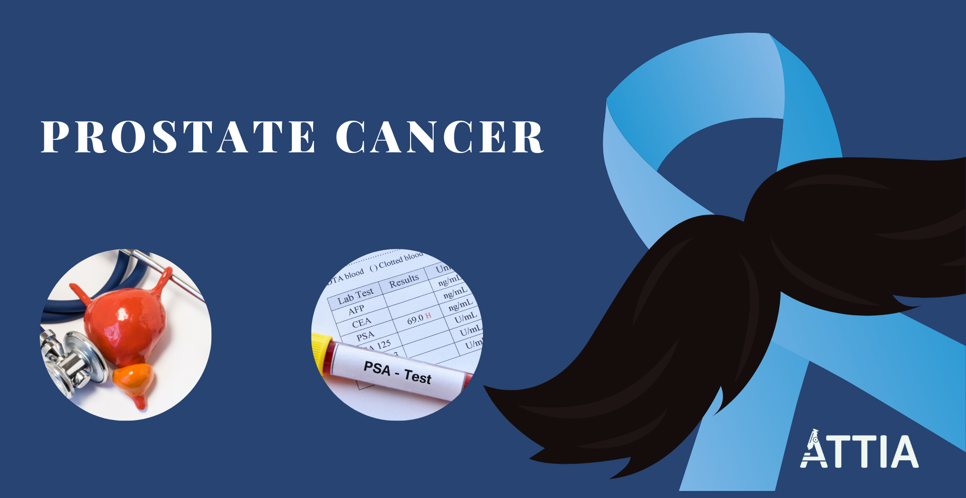 L'importance du PSA dans le dépistage précoce du cancer de la prostate ...